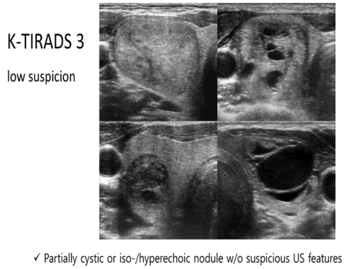 K-TIRADS 2021개정판 총정리 (증례로 보는 갑상선 결절의 최신지견) : 네이버 블로그
