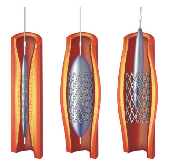 관상동맥(coronary artery)과 치료(CAG,PCI, PTCA,PTA) : 네이버 블로그