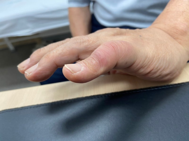 손가락 Button hole 변형, (Bouttenniere Deformity) - 손가락 신전건(central slip ...