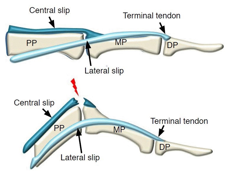 손가락 Button hole 변형, (Bouttenniere Deformity) - 손가락 신전건(central slip ...