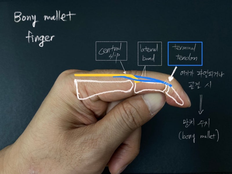 손가락 Button hole 변형, (Bouttenniere Deformity) - 손가락 신전건(central slip ...