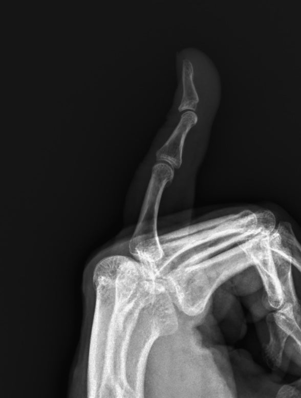 손가락 Button hole 변형, (Bouttenniere Deformity) - 손가락 신전건(central slip ...