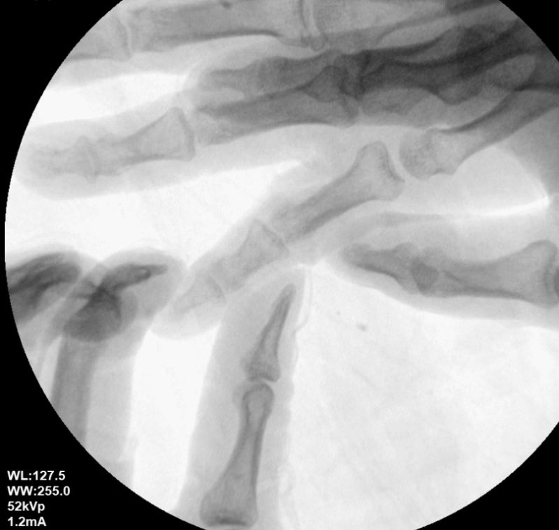 손가락 Button hole 변형, (Bouttenniere Deformity) - 손가락 신전건(central slip ...