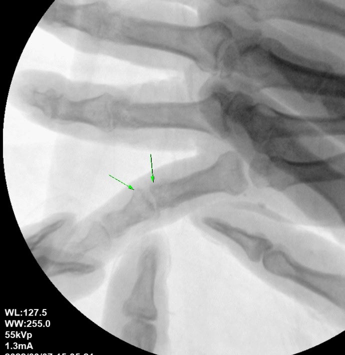 손가락 Button hole 변형, (Bouttenniere Deformity) - 손가락 신전건(central slip ...