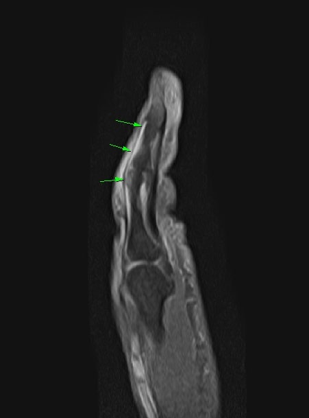 손가락 Button hole 변형, (Bouttenniere Deformity) - 손가락 신전건(central slip ...