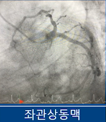관상동맥(coronary artery)과 치료(CAG,PCI, PTCA,PTA) : 네이버 블로그