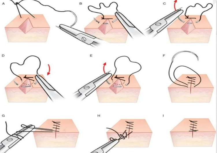 봉합(suture)의 종류, 신규 간호사, 수술실 : 네이버 블로그