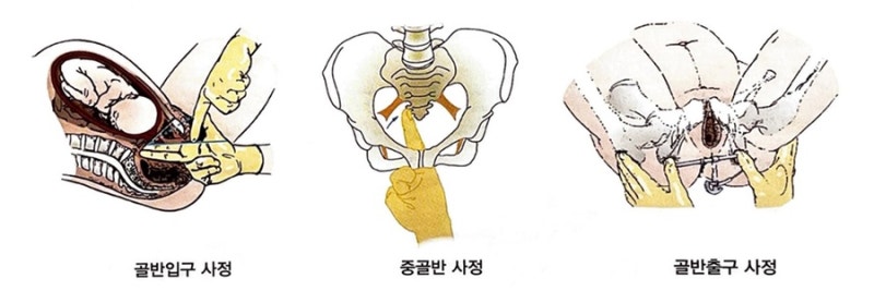 여성간호학 분만기 여성 분만 생리 대횡경선소사경선대사경선태위두위둔위견갑위대각결합선진결합선견축륜자궁수축