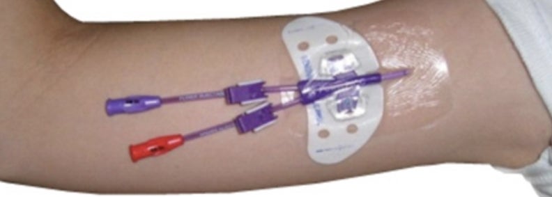 중심정맥관의 모든 것 [C-line, PICC, HD cath, perm cath, IJC, AVF, AVG] : 네이버 블로그