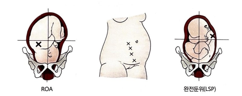 여성간호학 분만기 여성 분만 간호 분만통증레오폴드촉진법질내진파막검사나이트라진태아곤란증라마즈호흡법힘주기회음