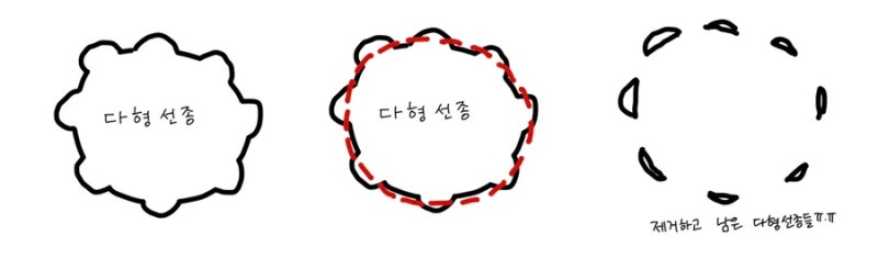 수술일지③ 침샘혹침샘종양 이하선종양 증상 땡큐이비인후과 첫진료팁 이하선종양 재발 원인 네이버 블로그