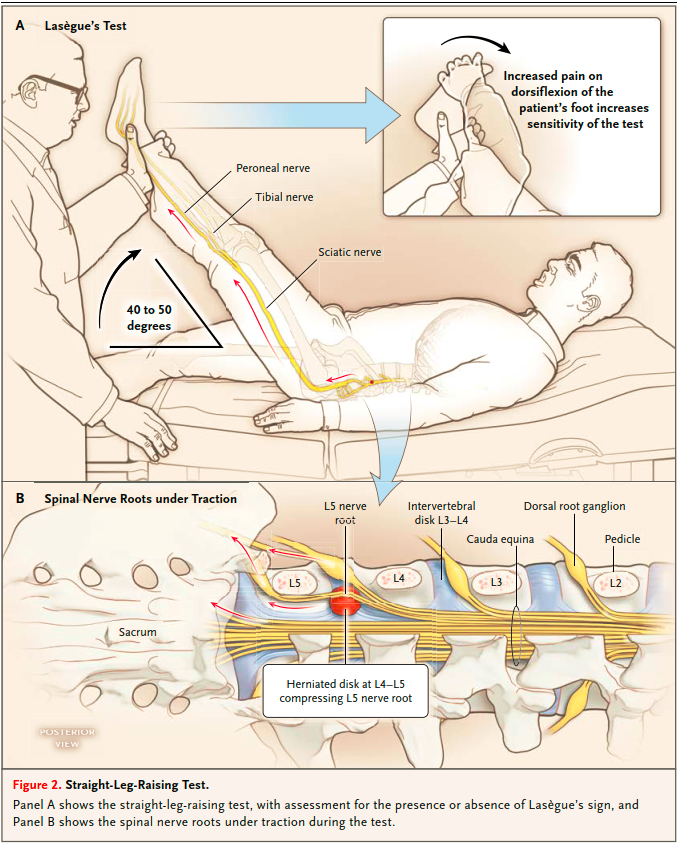 좌골신경통overview Of Sciatica 네이버 블로그