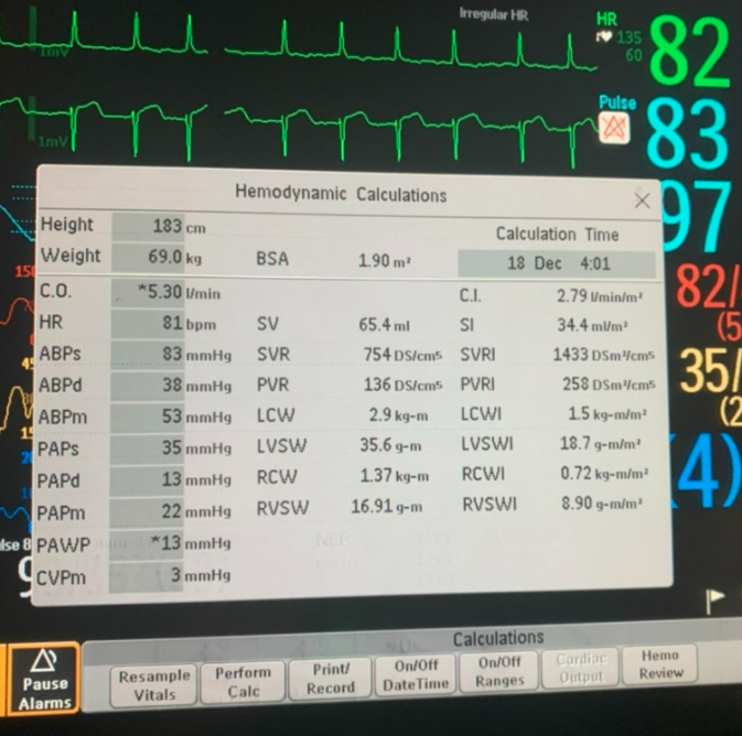swan-Ganz catheter(스완-간즈카테터) : 네이버 블로그
