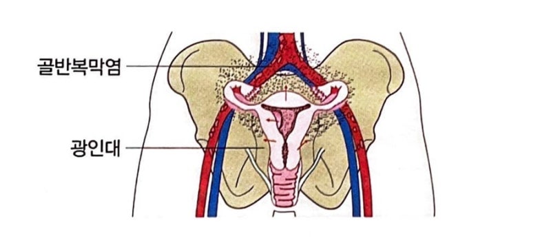 여성간호학 산욕기 여성 고위험 산욕 간호 산욕감염자궁내막염혈전성정맥염색전증폐색전증유방염방광염산후출혈자궁