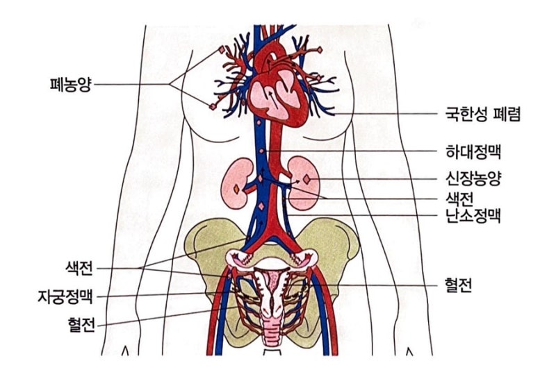 여성간호학 산욕기 여성 고위험 산욕 간호 산욕감염자궁내막염혈전성정맥염색전증폐색전증유방염방광염산후출혈자궁