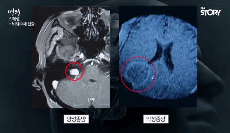 뇌종양 진단등급★양성뇌종양과 악성뇌종양 구분방법★뇌하수체선종 네이버 블로그