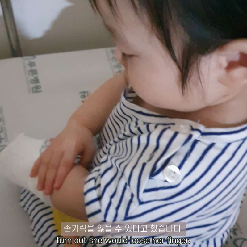 아기화상 깊은 2도화상 3도 화상 수술 없이 깨끗하게 나은 후기 네이버 블로그