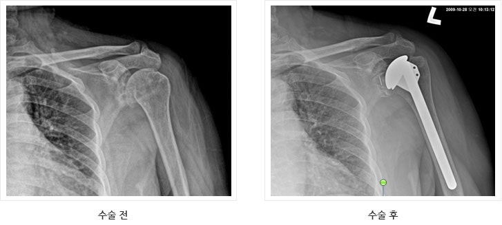 [나래병원, 어깨] 역행성 어깨 인공관절치환술, reverse TSR : 네이버 블로그