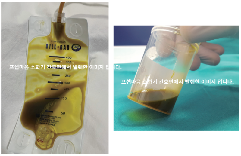 의학용어 PTGBD 시술 후 간호, 배액관 관리, 노티 기준 : 네이버 블로그