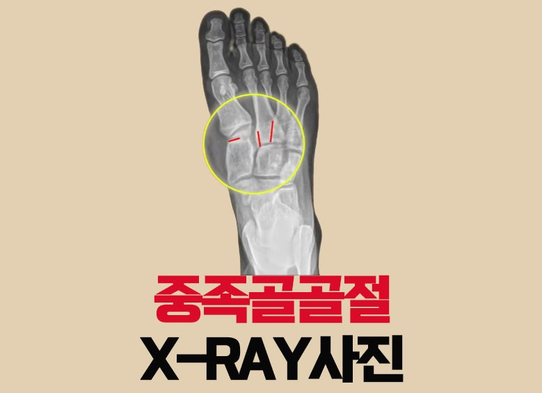 5번 중족골 골절 통증 후유장해 가능성 알아보기 네이버 블로그