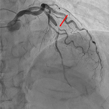 관상동맥(coronary artery)과 치료(CAG,PCI, PTCA,PTA) : 네이버 블로그