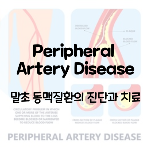 말초동맥질환의 진단과 치료 Peripheral Artery Disease, PAOD (PTA, Stent-graft ...