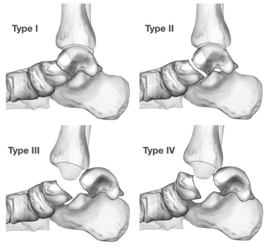 Trimalleolar Fracture(삼과 골절) : 네이버 블로그