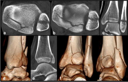 Trimalleolar Fracture(삼과 골절) : 네이버 블로그
