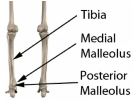 Trimalleolar Fracture(삼과 골절) : 네이버 블로그