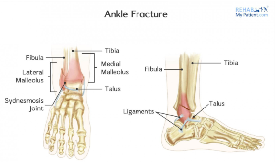 Trimalleolar Fracture(삼과 골절) : 네이버 블로그