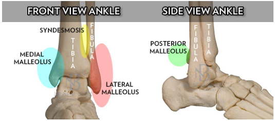 Trimalleolar Fracture(삼과 골절) : 네이버 블로그