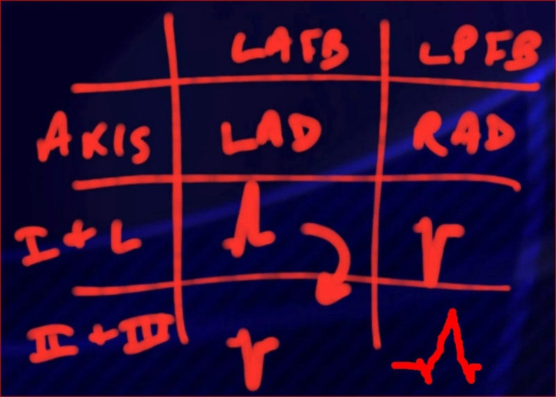 심전도, Left anterior fascicular block (LAFB)과 left posterior fascicular ...
