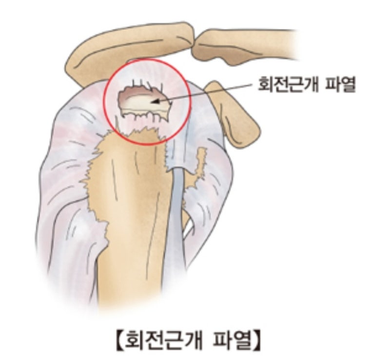 퇴행성관절염 류머티스관절염 어깨회전근개파열 연골파열을 줄기세포로 치료 네이버 블로그