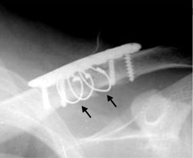 os신규,plate종류,lcp,rcp,dcp,anatomical plate : 네이버 블로그
