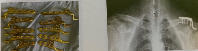 os신규,plate종류,lcp,rcp,dcp,anatomical plate : 네이버 블로그