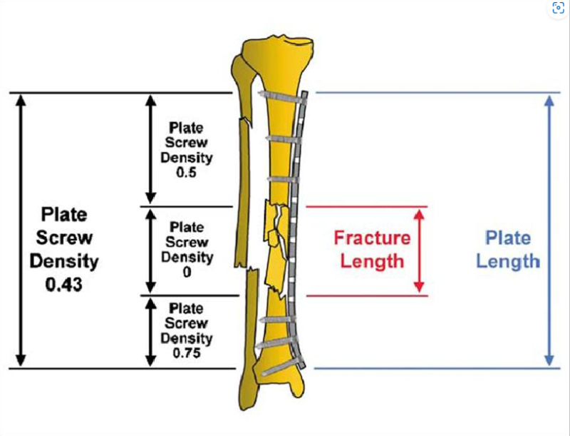 os신규,plate종류,lcp,rcp,dcp,anatomical plate : 네이버 블로그
