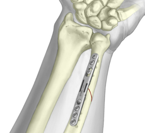 os신규,plate종류,lcp,rcp,dcp,anatomical plate : 네이버 블로그