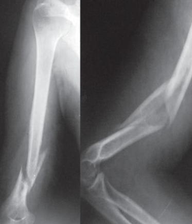 os신규,plate종류,lcp,rcp,dcp,anatomical plate : 네이버 블로그