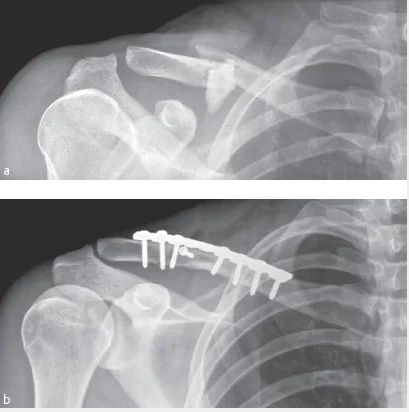 os신규,plate종류,lcp,rcp,dcp,anatomical plate : 네이버 블로그