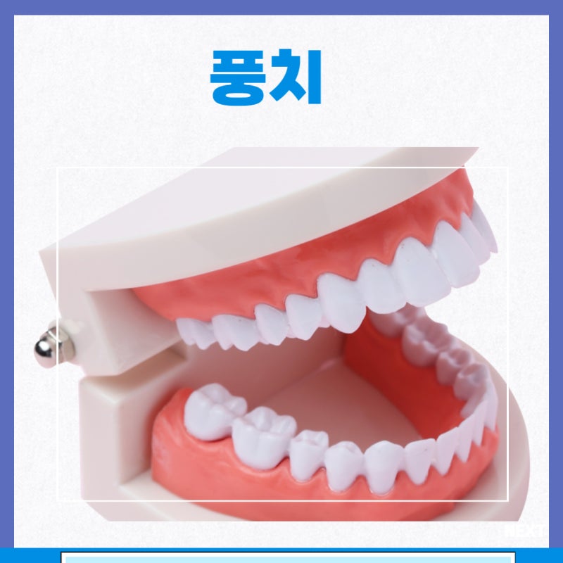 풍치 원인 증상 치료 예방 치근활택술 치주소파술 치주판막술 치석제거 네이버 블로그