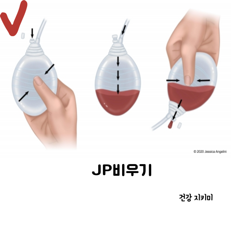 간호사 Tip 수술 후 배액관 종류hemovac Barovac Jp 관리 방법 네이버 블로그