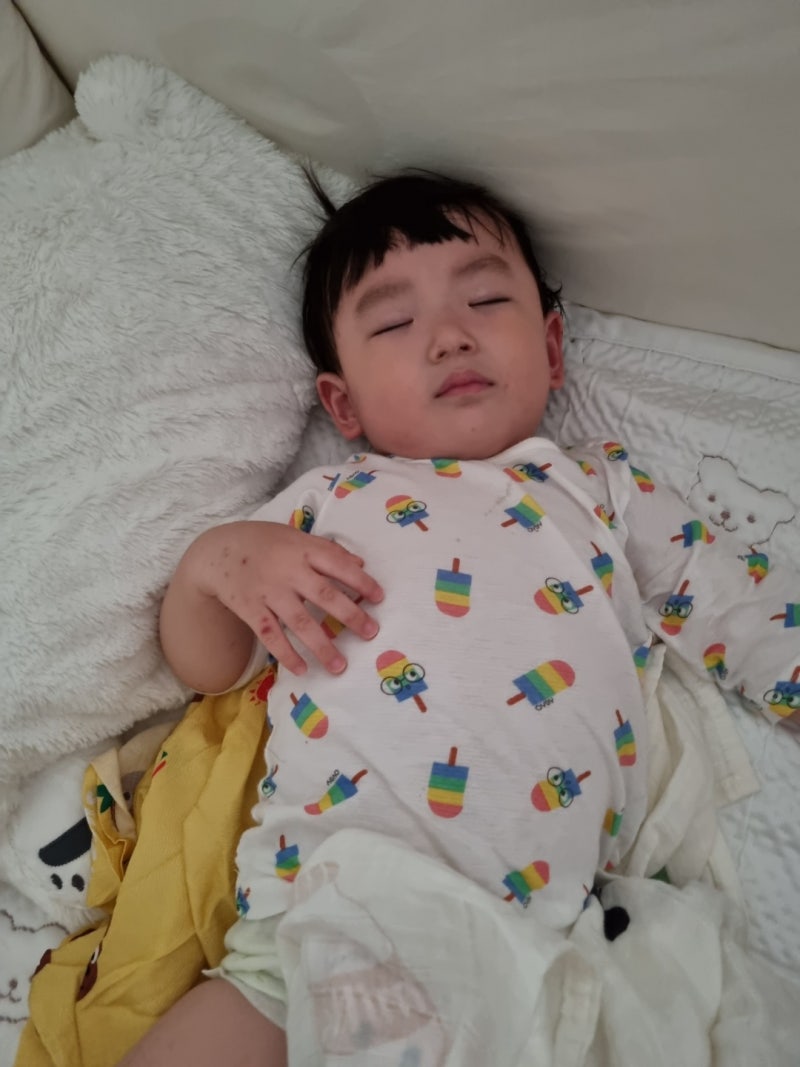 20개월 아기 수족구 엄마아빠 온 가족 수족구 어른 수족구 증상안옮는 팁 2 네이버 블로그