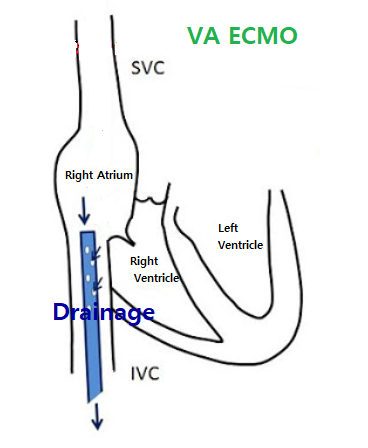 ECMO의 기본개념과 VA ECMO(Venoarterial ECMO) & VV ECMO(Venovenous ECMO) : 네이버 블로그