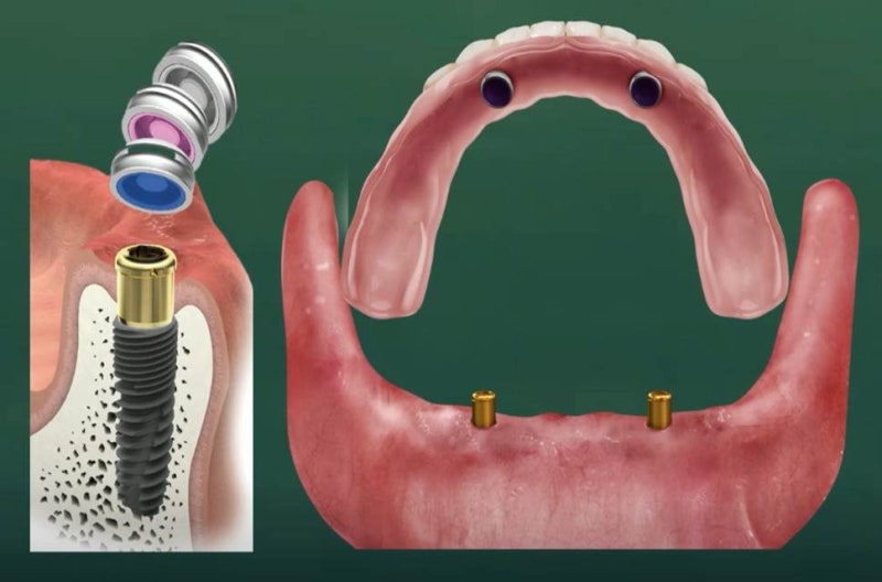 [백은준 수석원장님 칼럼] Locator(로케이터)를 이용한 Implant Overdenture : 네이버 블로그