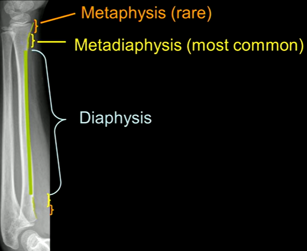 [소아 골절] 불완전 골절(Incomplete Fracture) & 성장판 손상 : 네이버 블로그