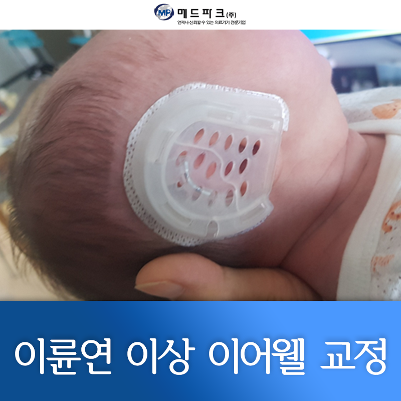 이어웰 신생아 교정 후기 (이륜연 이상 Helical Rim Deformities) : 네이버 블로그
