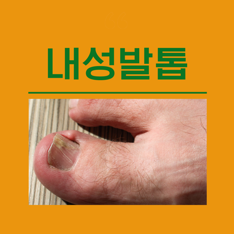 내향성발톱 원인 증상 자가치료 바르는 손발톱무좀약 추천 먹는약 여자 엄지 염증 곰팡이 두꺼워짐 교정 네이버 블로그