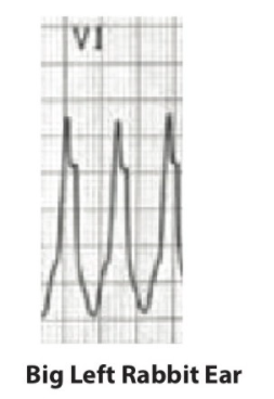 심실빈맥 심전도 특징 ①, Ventricular tachycardia, ECG tutorial : 네이버 블로그