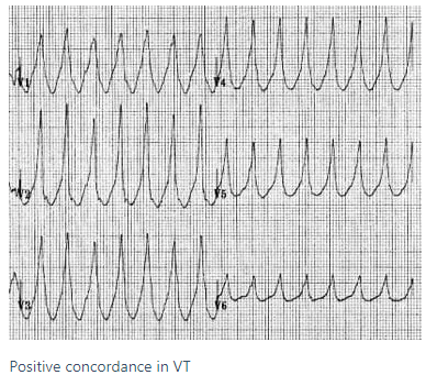 심실빈맥 심전도 특징 ①, Ventricular tachycardia, ECG tutorial : 네이버 블로그