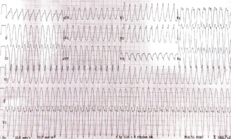 Electrical storm [VT storm, VF storm] : 네이버 블로그